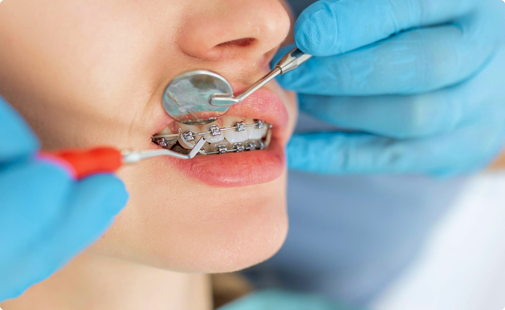 Dental Braces by Expert Orthodontists | Straighten Your Smile