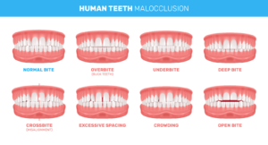5 Common Causes of Crooked Teeth and How to Treat Them
