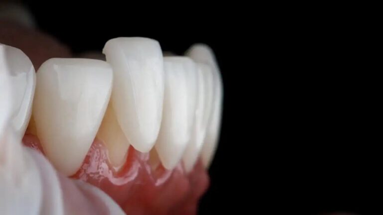 5 Common Causes of Crooked Teeth and How to Treat Them